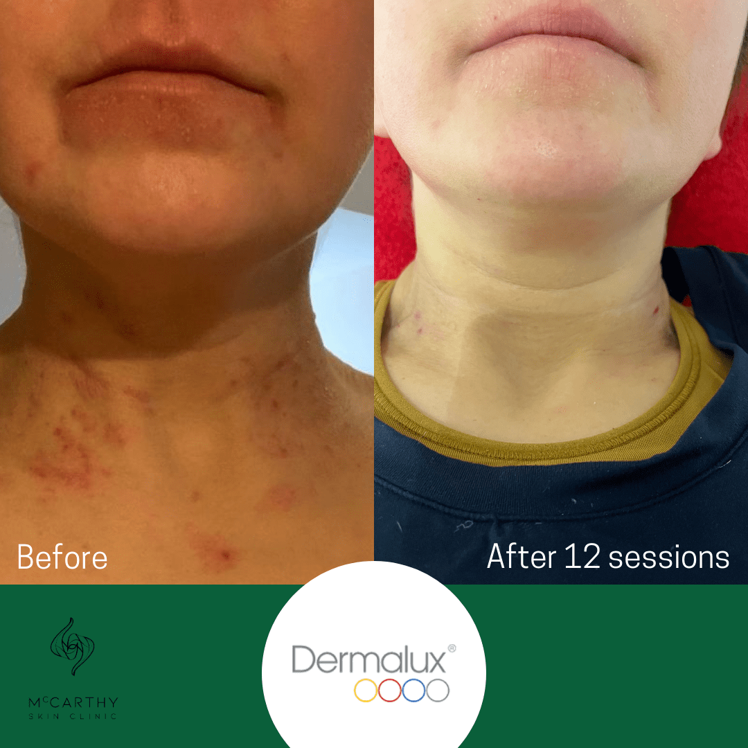 Dermalux LED Phototherapy Milton Keynes | McCarthy Skin Clinic